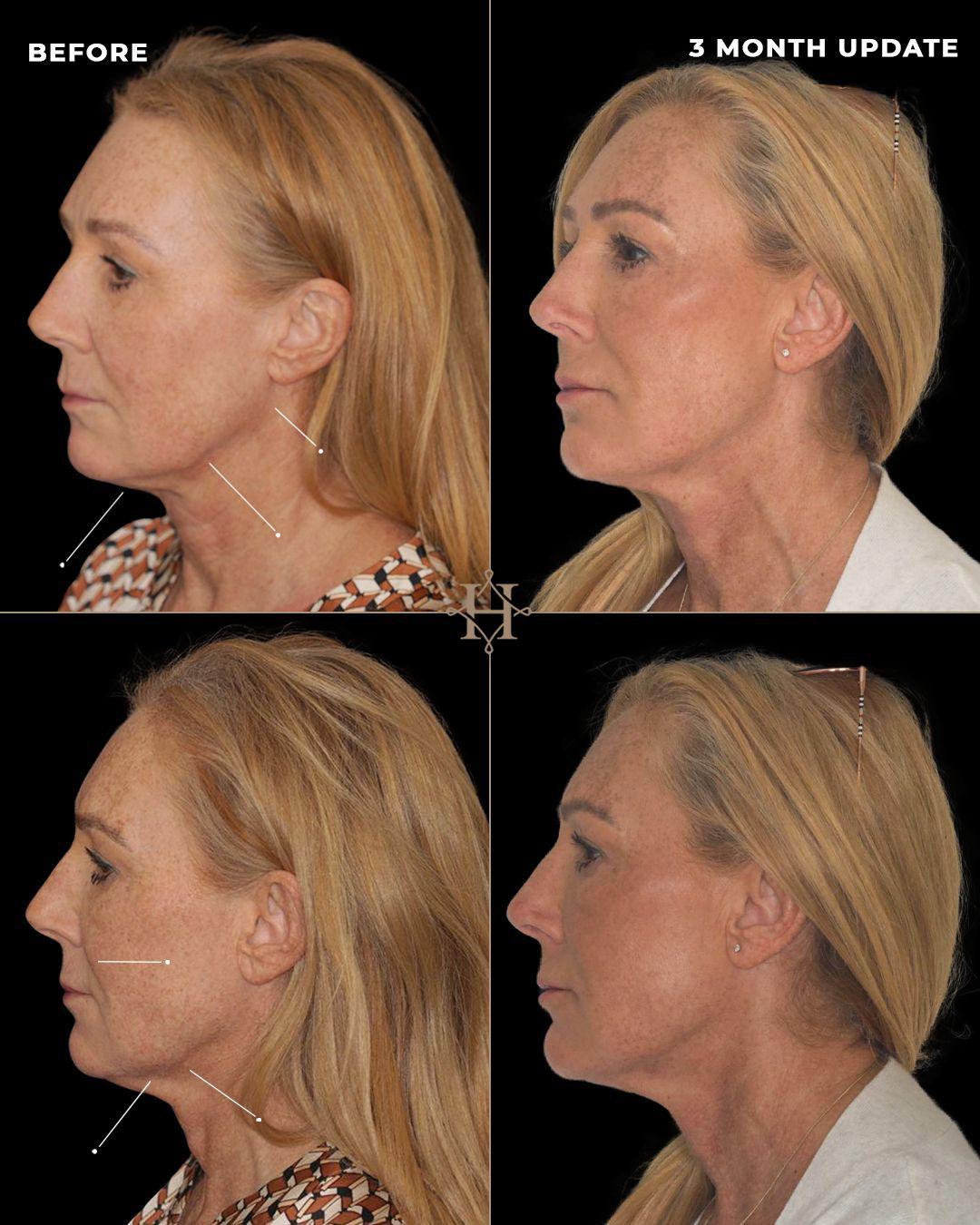 Endolift – HPD health & well-being