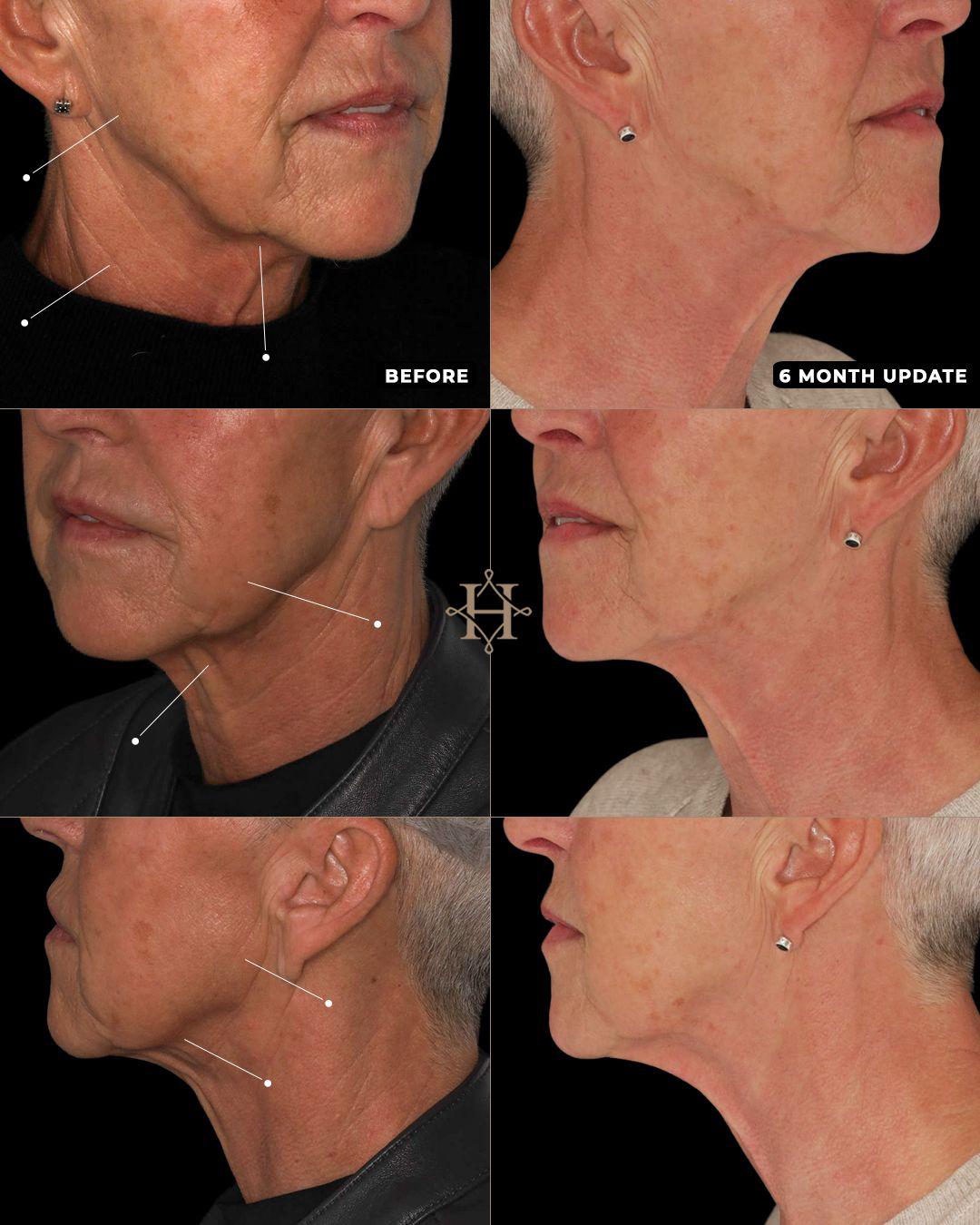 Endolift – HPD health & well-being