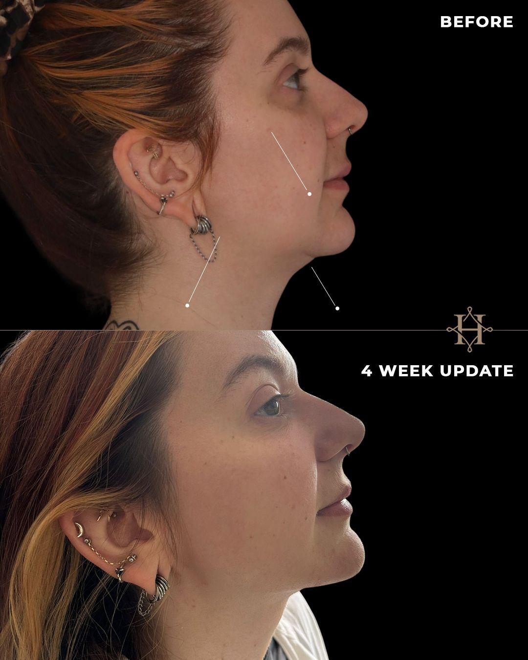 Endolift – HPD health & well-being